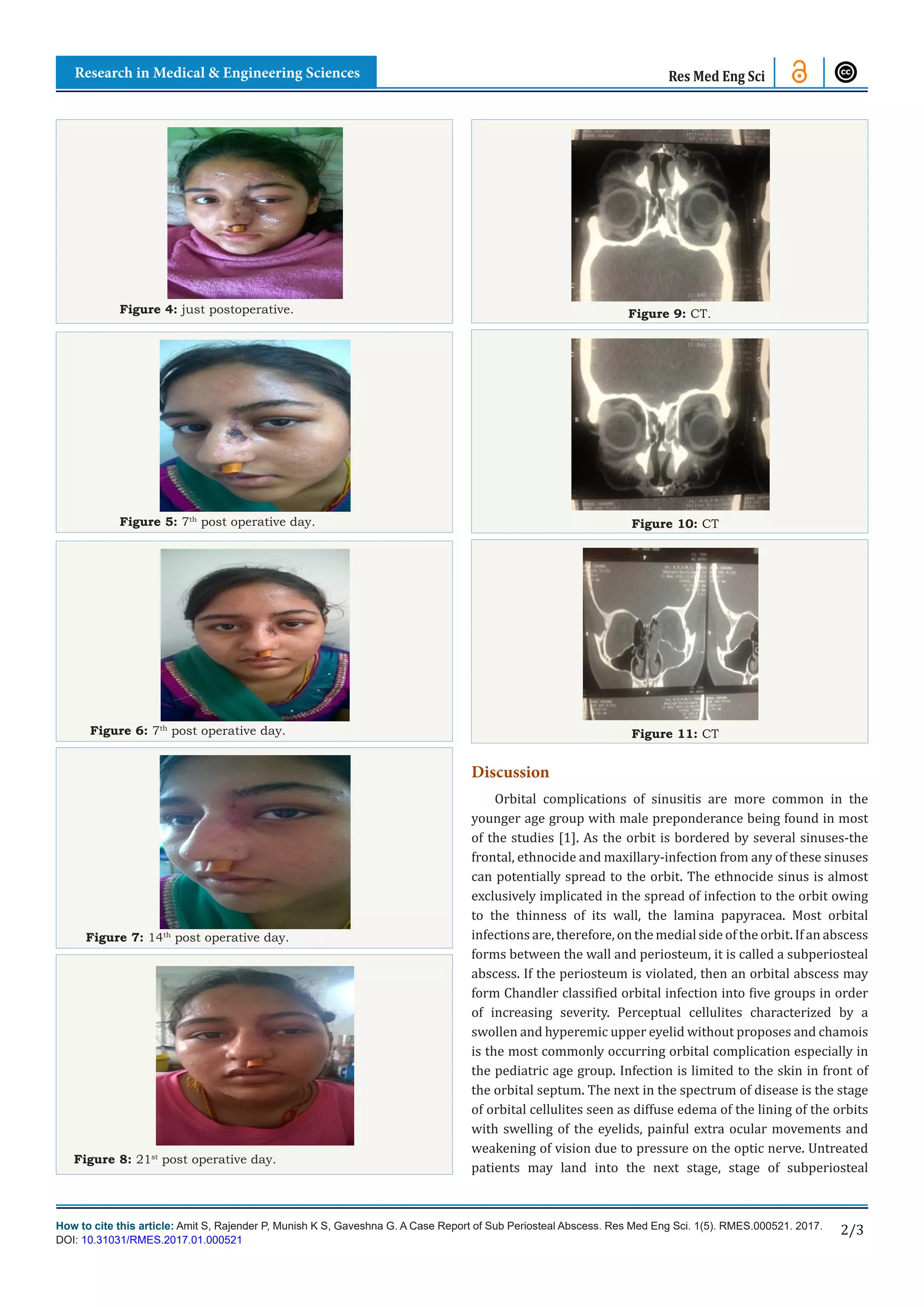 A Case Report of Sub Periosteal Abscess | Crimson Publishers | PDF