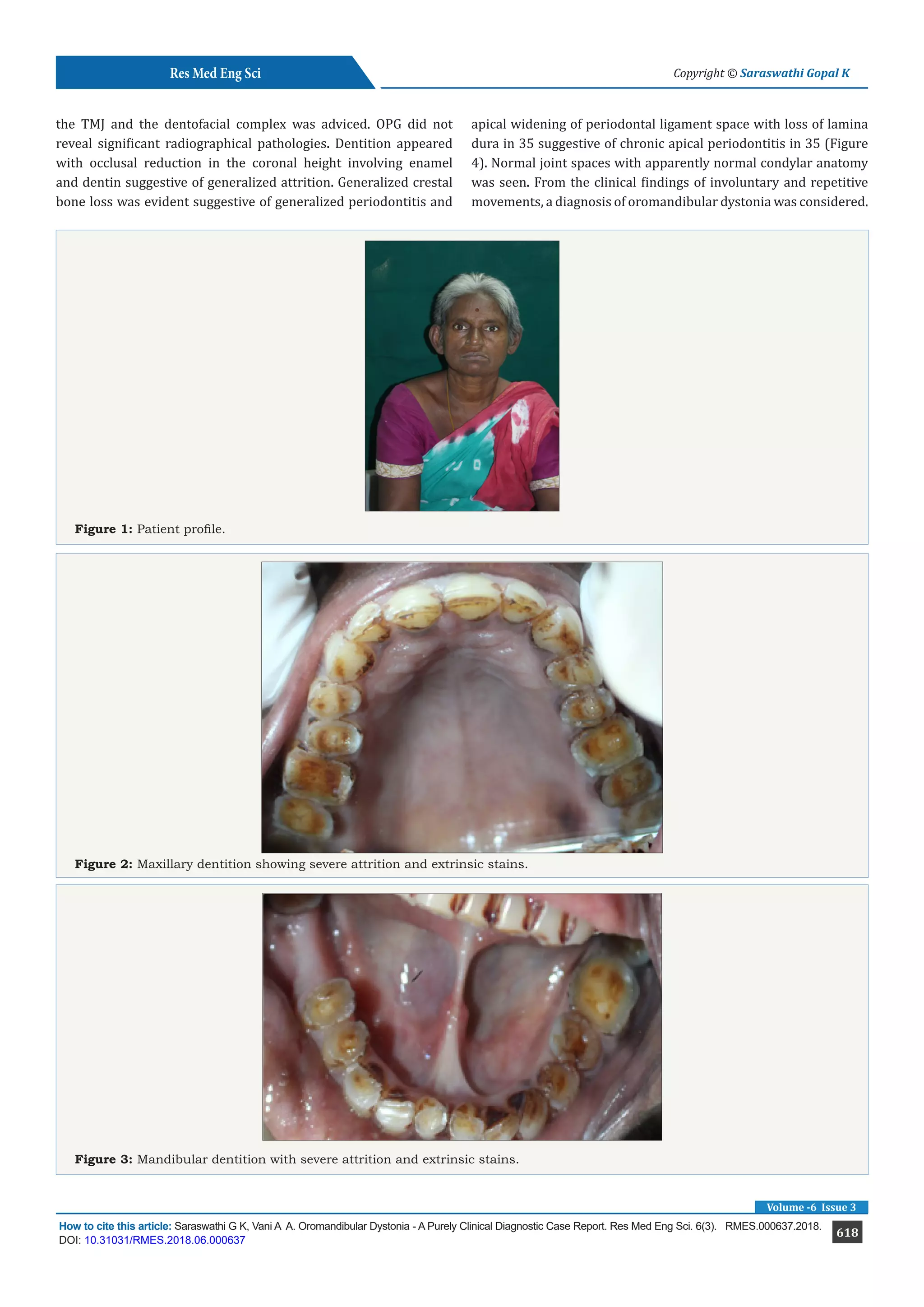 Oromandibular Dystonia - A Purely Clinical Diagnostic Case Report | PDF