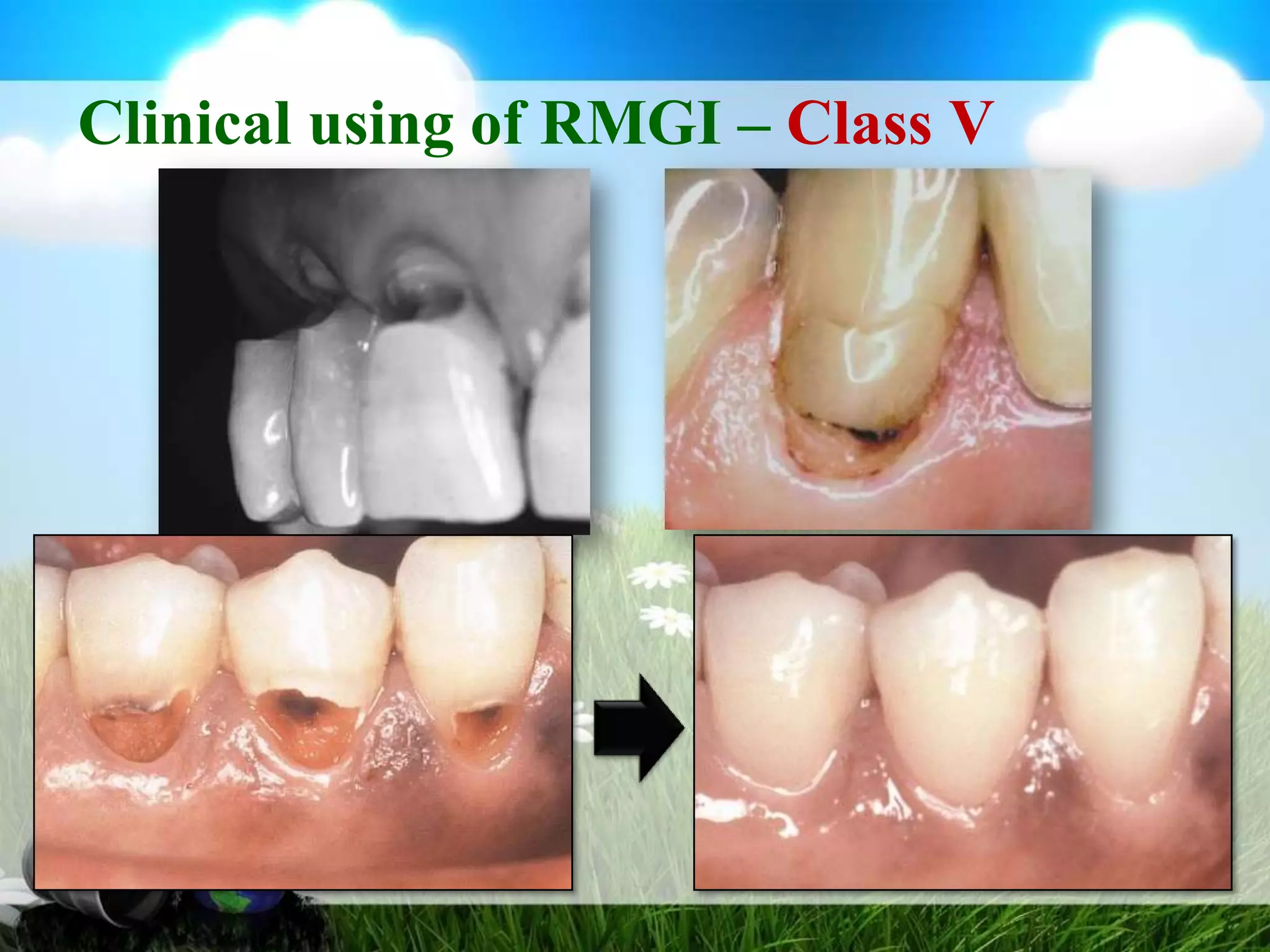 Resin Modified Glassionomer cement | PPTX