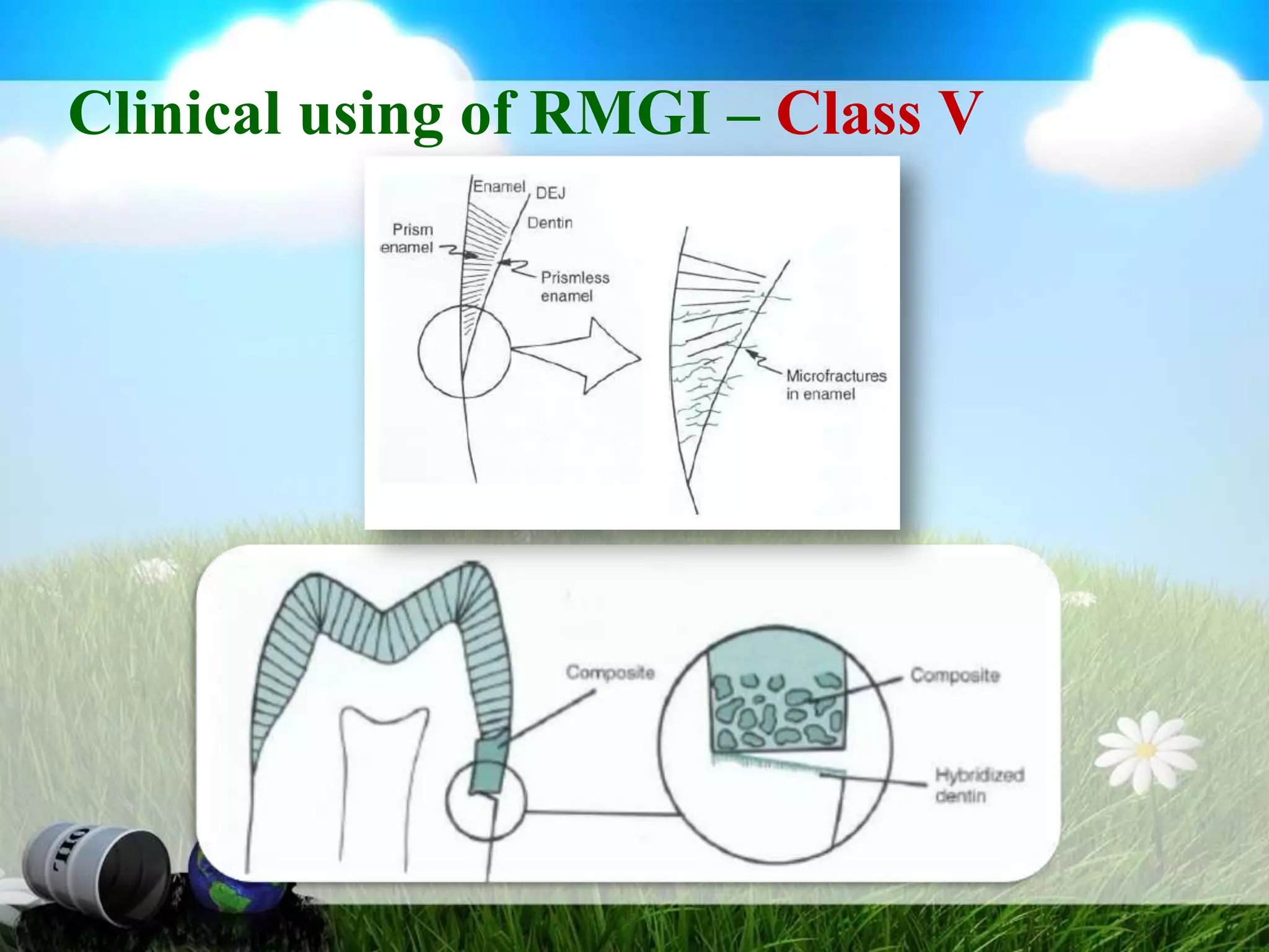 Resin Modified Glassionomer cement | PPTX