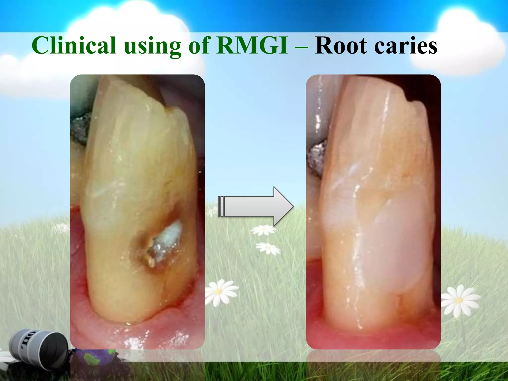 Resin Modified Glassionomer cement | PPTX