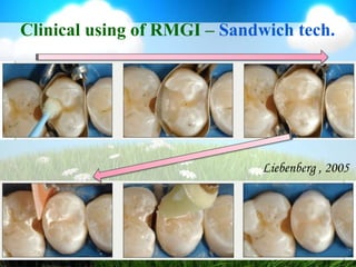 Resin Modified Glassionomer cement | PPTX
