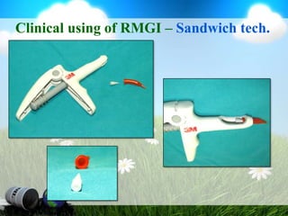 Resin Modified Glassionomer cement | PPTX