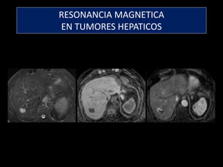 resonancia-magnetica-de-higado-y-vias-biliares-pptx