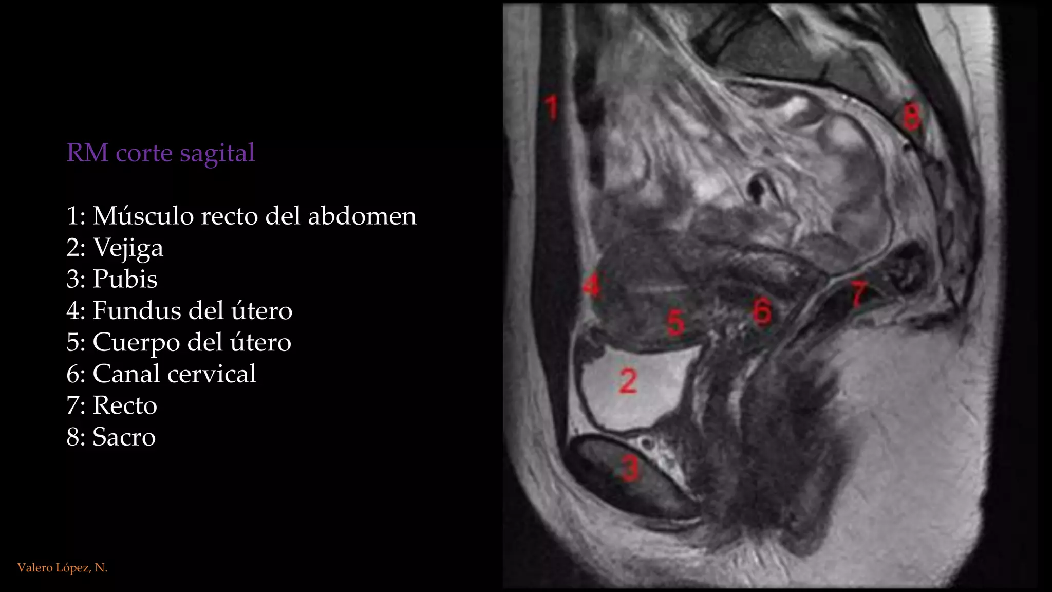 Anatomía Por La Imagen Rm Histerosalpingografía Genitales Mujer
