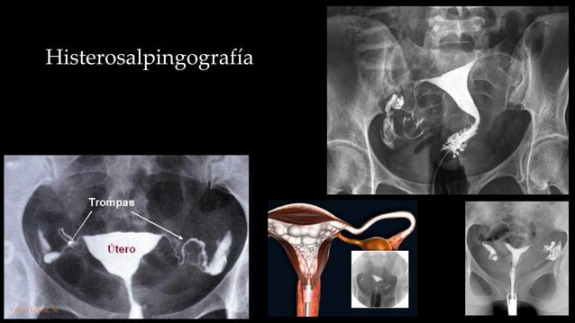 Anatomía por la imagen. Rm, histerosalpingografía. genitales mujer ...