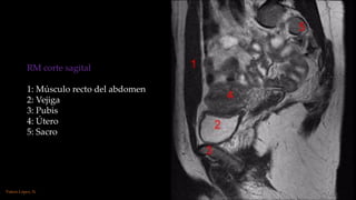 Resonancia Magnética De La Anatomía De Los Músculos Pélvicos