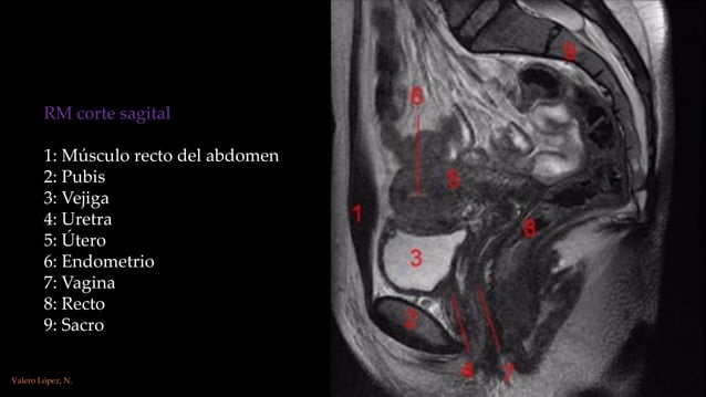 Anatomía Por La Imagen Rm Histerosalpingografía Genitales Mujer