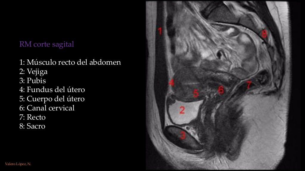 Anatomía por la imagen. Rm, histerosalpingografía. genitales mujer.