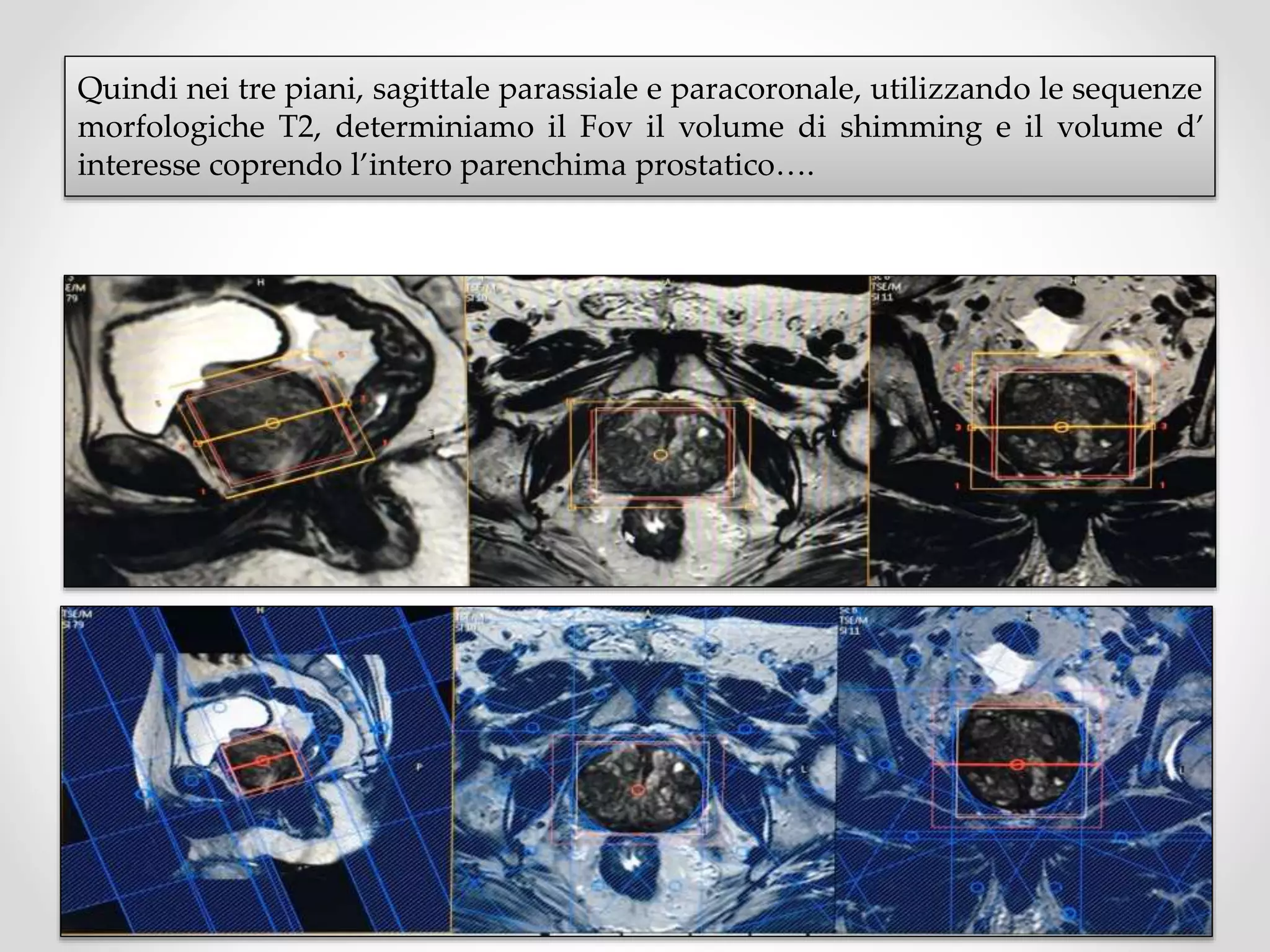 Multiparametric MRI for prostate cancer,executed by Giuseppe Scappatura ...