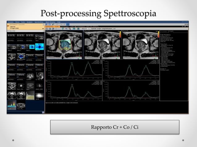 Multiparametric MRI for prostate cancer,executed by Giuseppe Scappatura ...