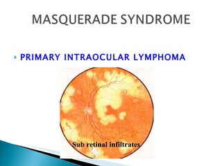 Masquerade Syndromes | PPT