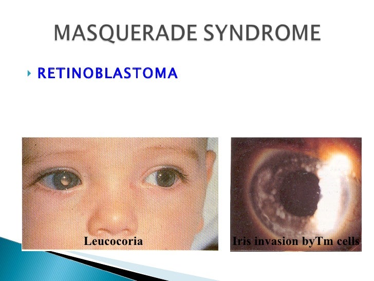 Masquerade-Syndrom | Innovative Diagnostik bei seltenen Tumoren des ...
