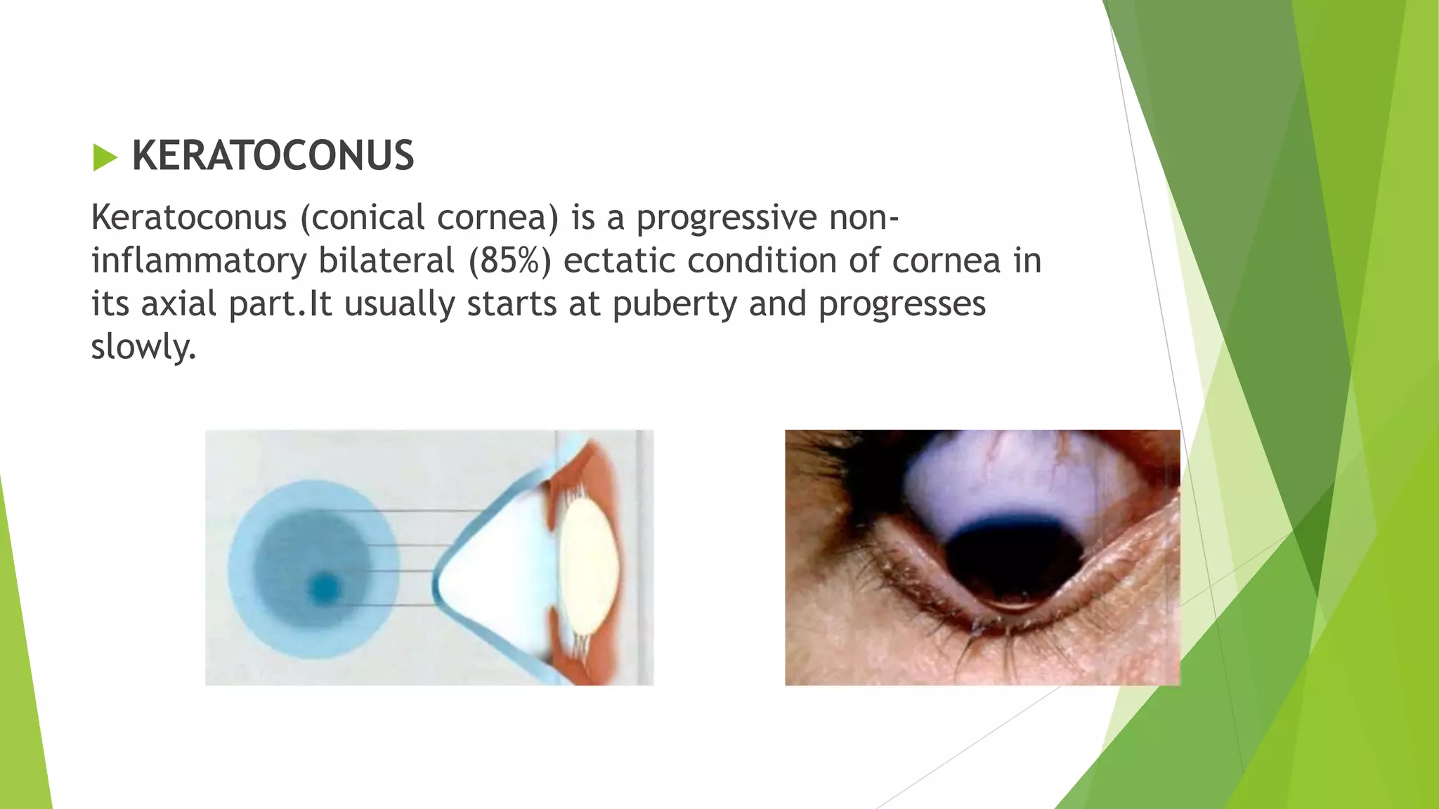 Abnormalities of Shape of Cornea and Corneal Opacity.pptx