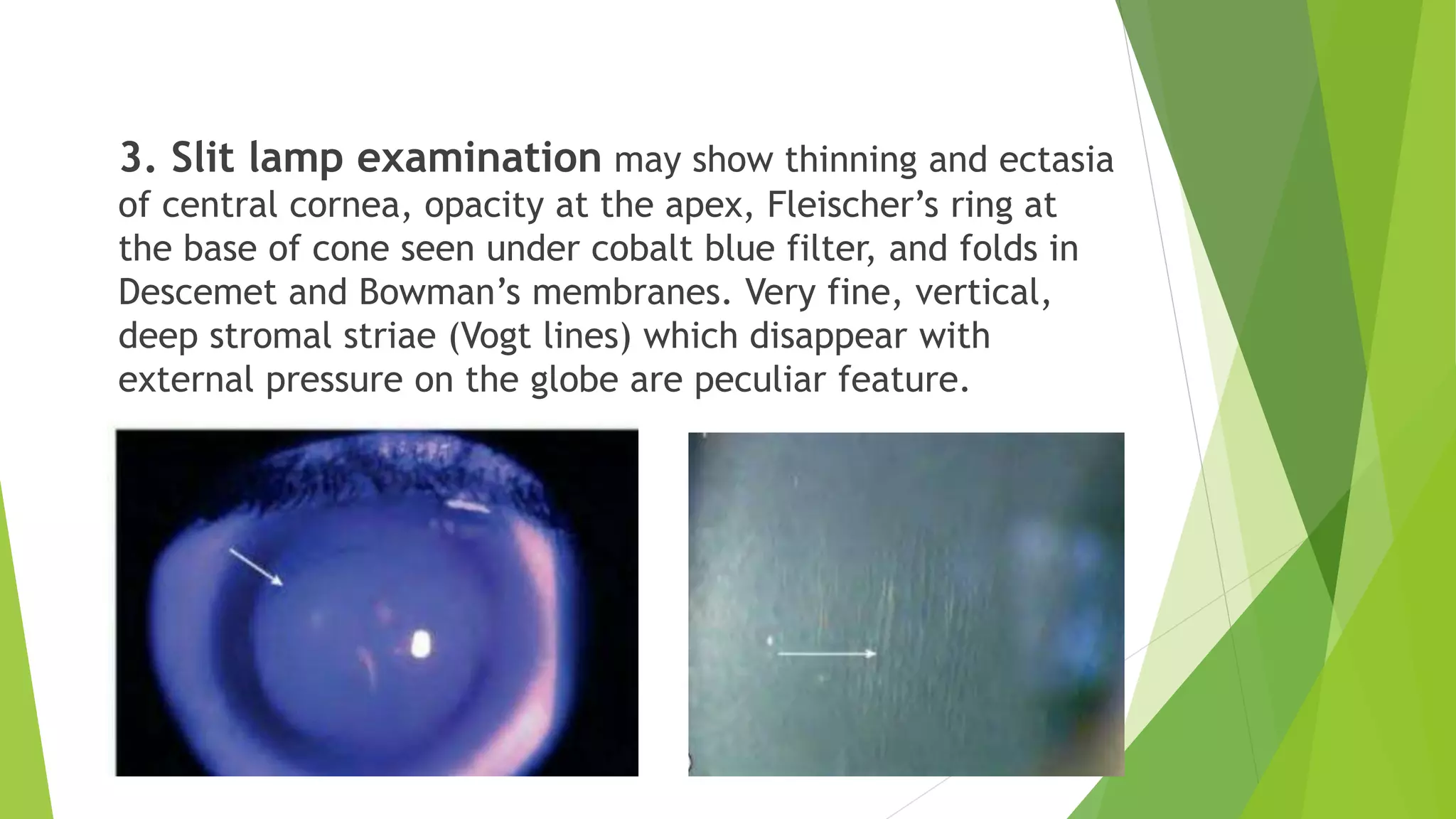 Abnormalities of Shape of Cornea and Corneal Opacity.pptx