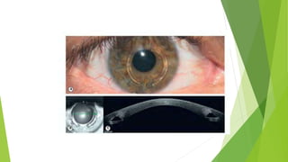 Abnormalities of Shape of Cornea and Corneal Opacity.pptx
