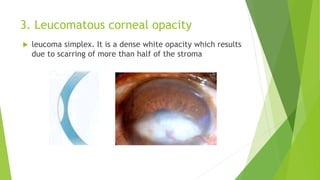 Abnormalities of Shape of Cornea and Corneal Opacity.pptx
