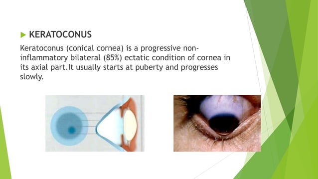 Abnormalities of Shape of Cornea and Corneal Opacity.pptx
