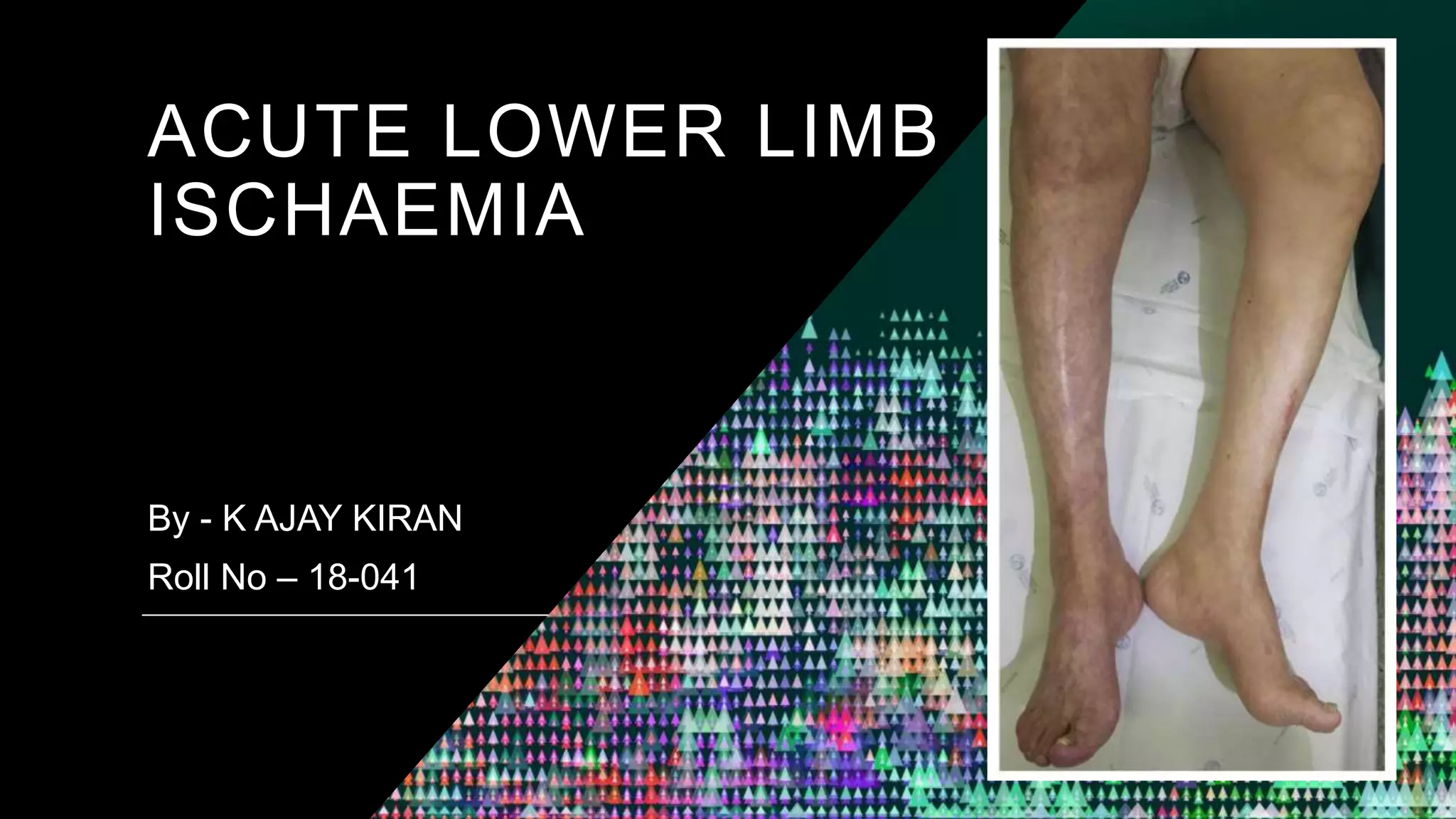 Acute Lower Limb Ischaemia.pptx