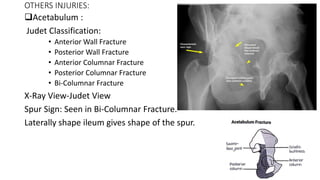 INJURIES OF PELVIS.pptx | First Aid | Injuries