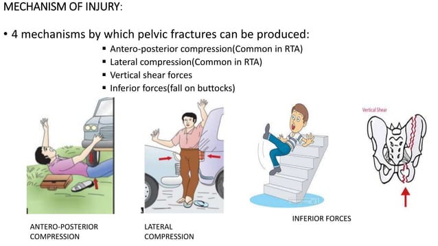 INJURIES OF PELVIS.pptx