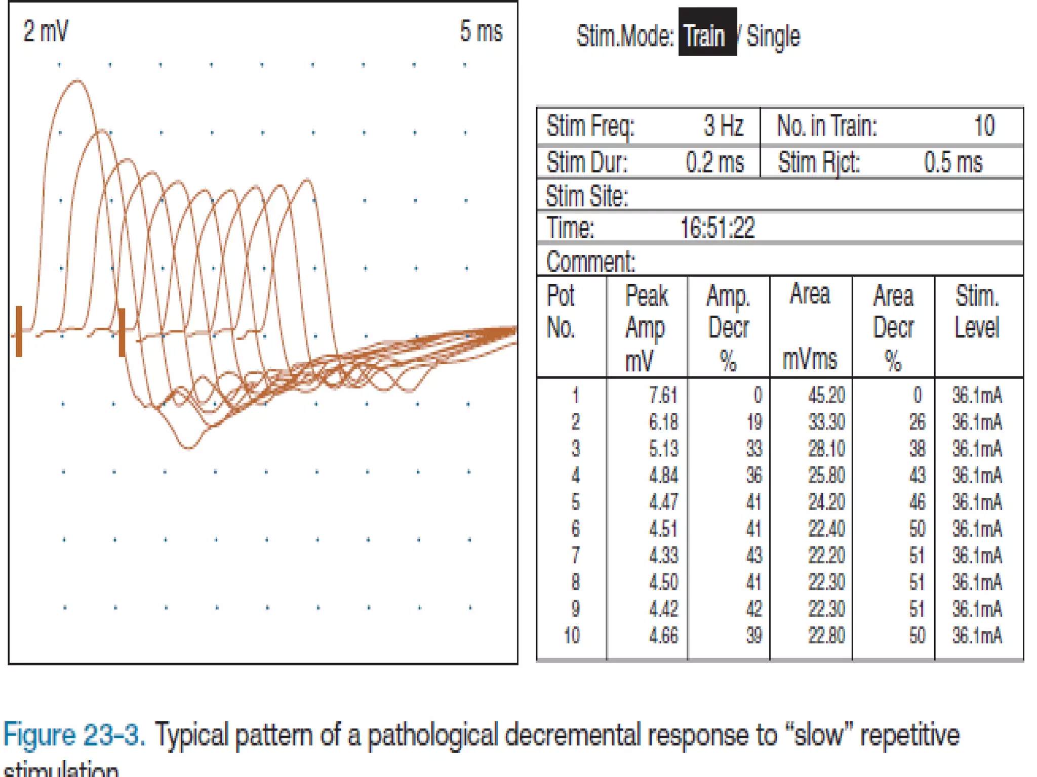 REPETITIVE NERVE STIMULATION (RNS) | PPT