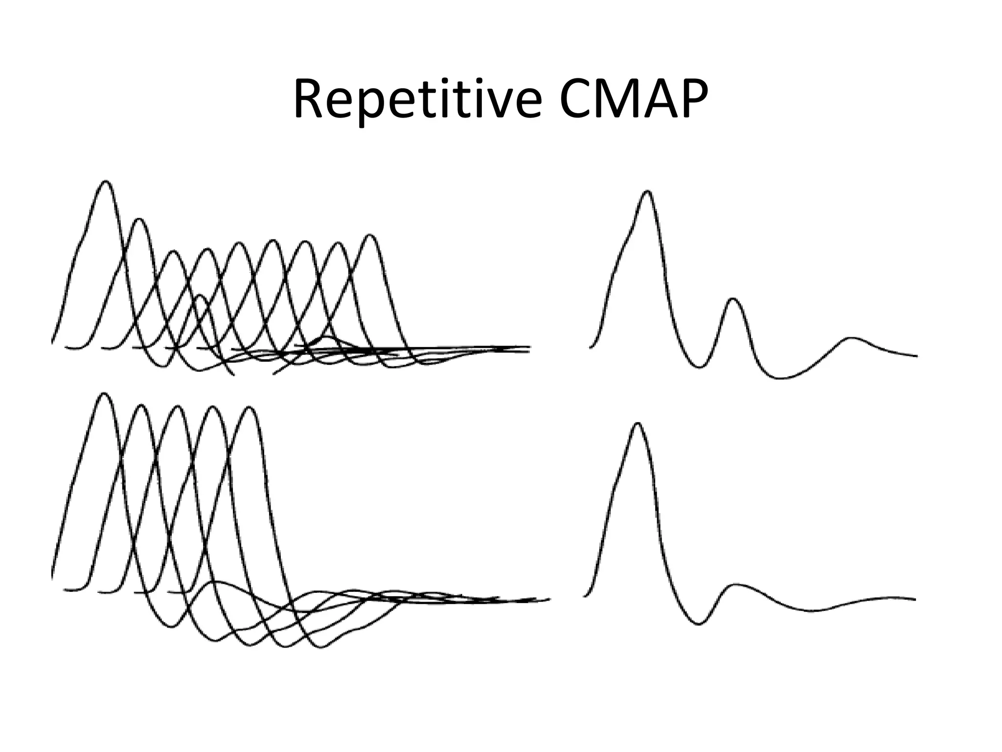 REPETITIVE NERVE STIMULATION (RNS) | PPT