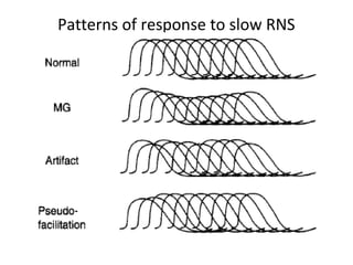REPETITIVE NERVE STIMULATION (RNS) | PPT