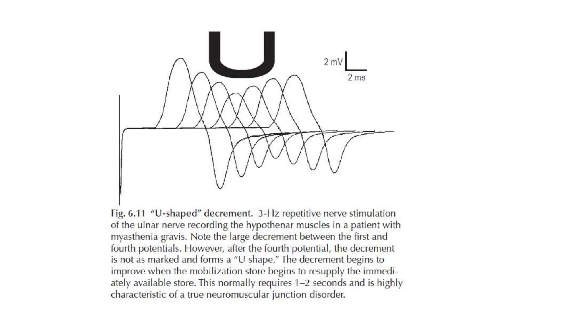 RNS diagnosis of myasthenia and lambert eaton .pptx