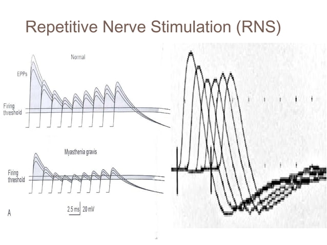 Repetitive Nerve Stimulation (RNS) | PPT | Physical Therapy | Wellness