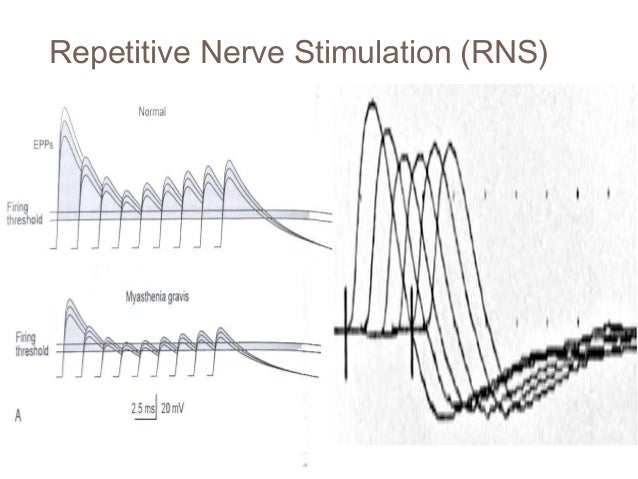 Repetitive Nerve Stimulation (RNS)