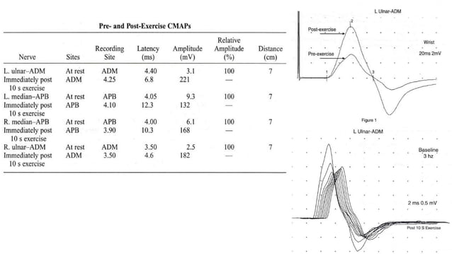 Repetitive nerve stimulation test | PPT