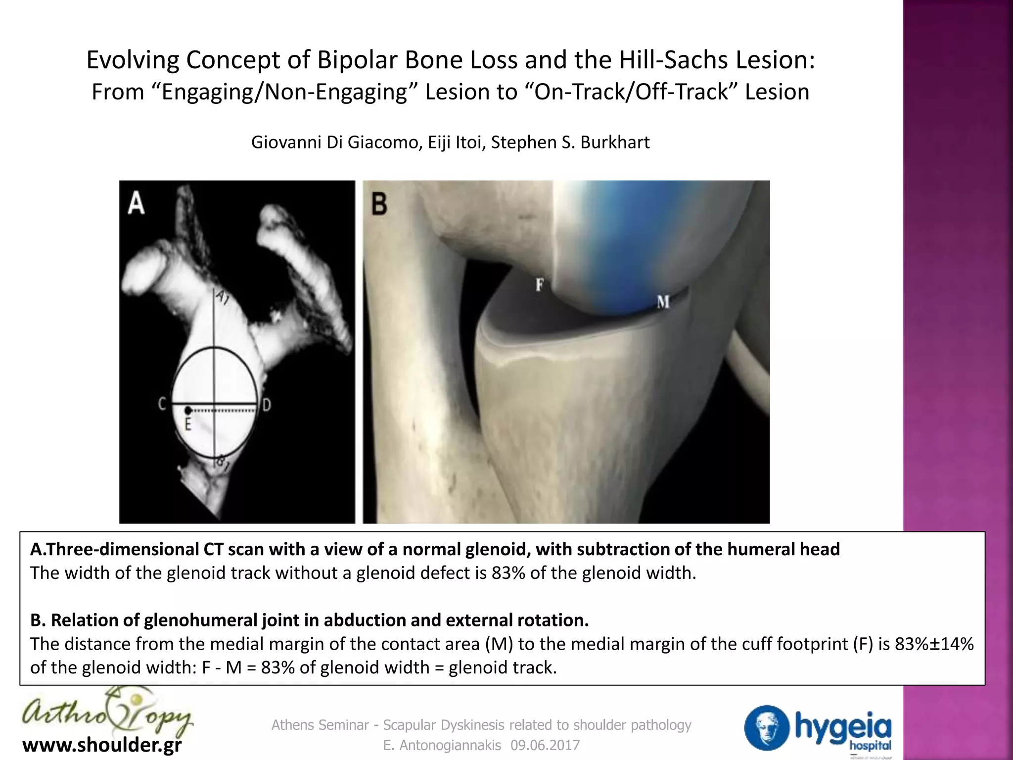 Traumatic glenohumeral instability final | PPTX