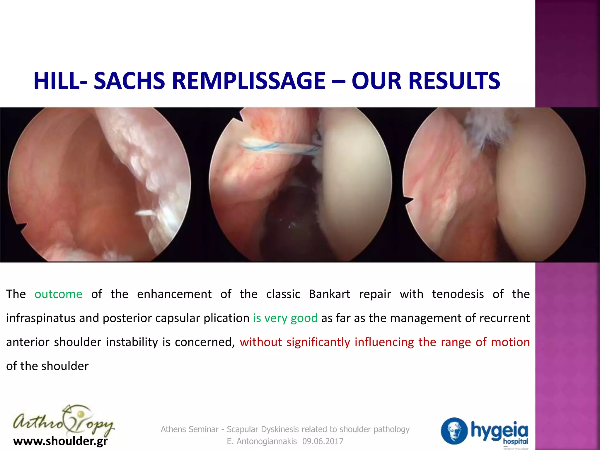 Traumatic glenohumeral instability final | PPTX
