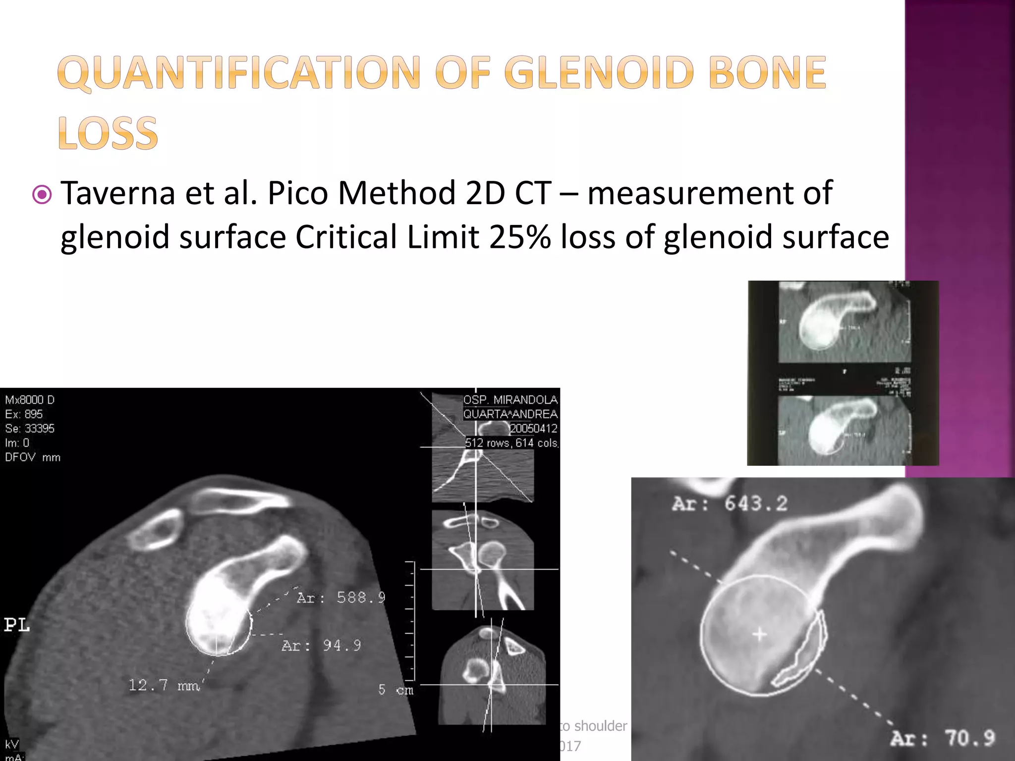 Traumatic glenohumeral instability final | PPTX