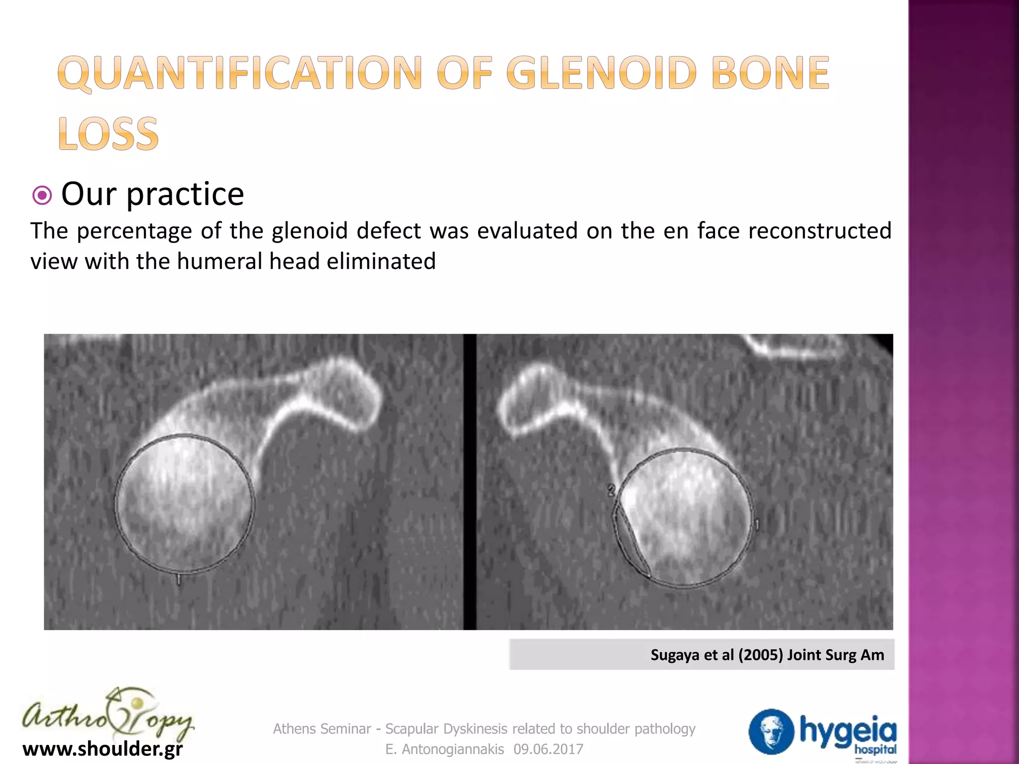 Traumatic glenohumeral instability final | PPTX