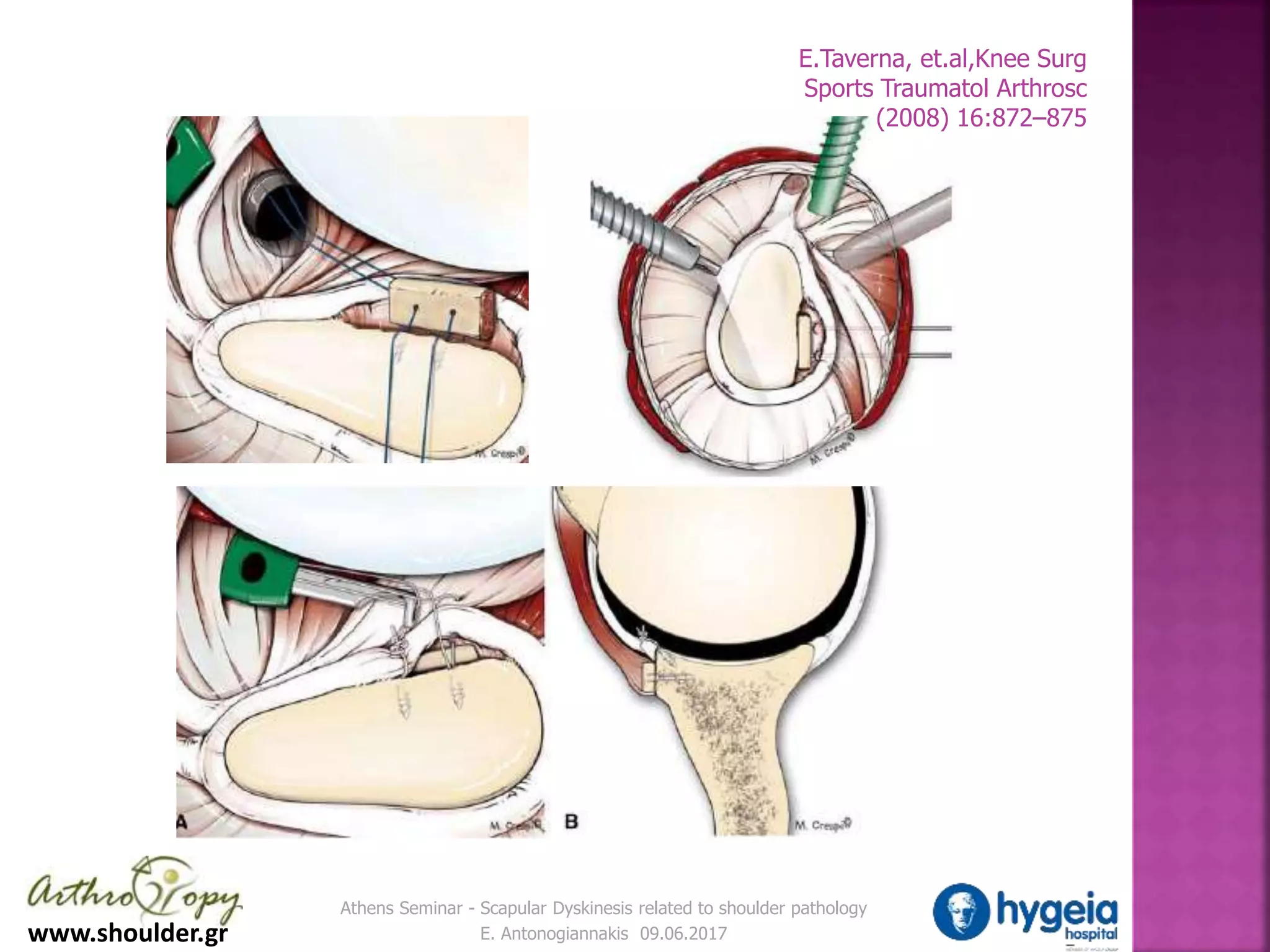 Traumatic glenohumeral instability final | PPTX