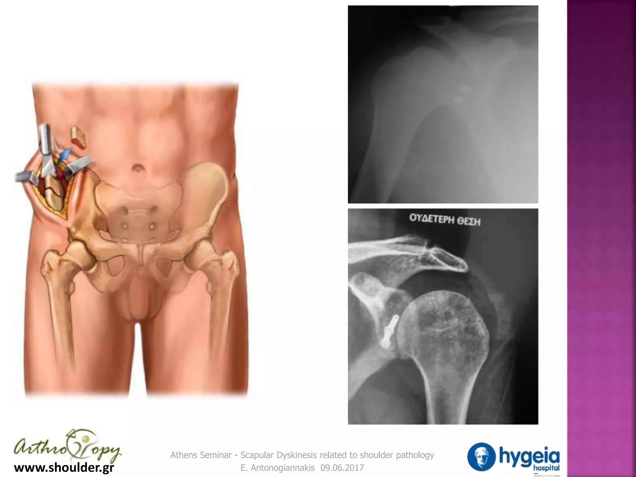 Traumatic glenohumeral instability final | PPTX