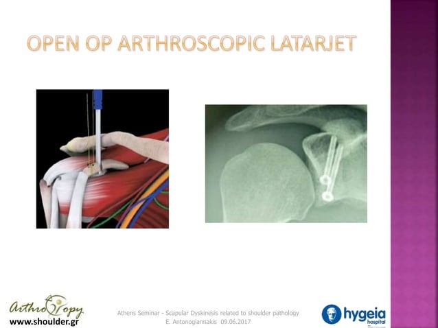 Traumatic glenohumeral instability final | PPTX