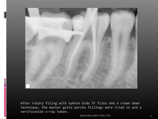 Road Map to a Successful Root Canal. | PPT