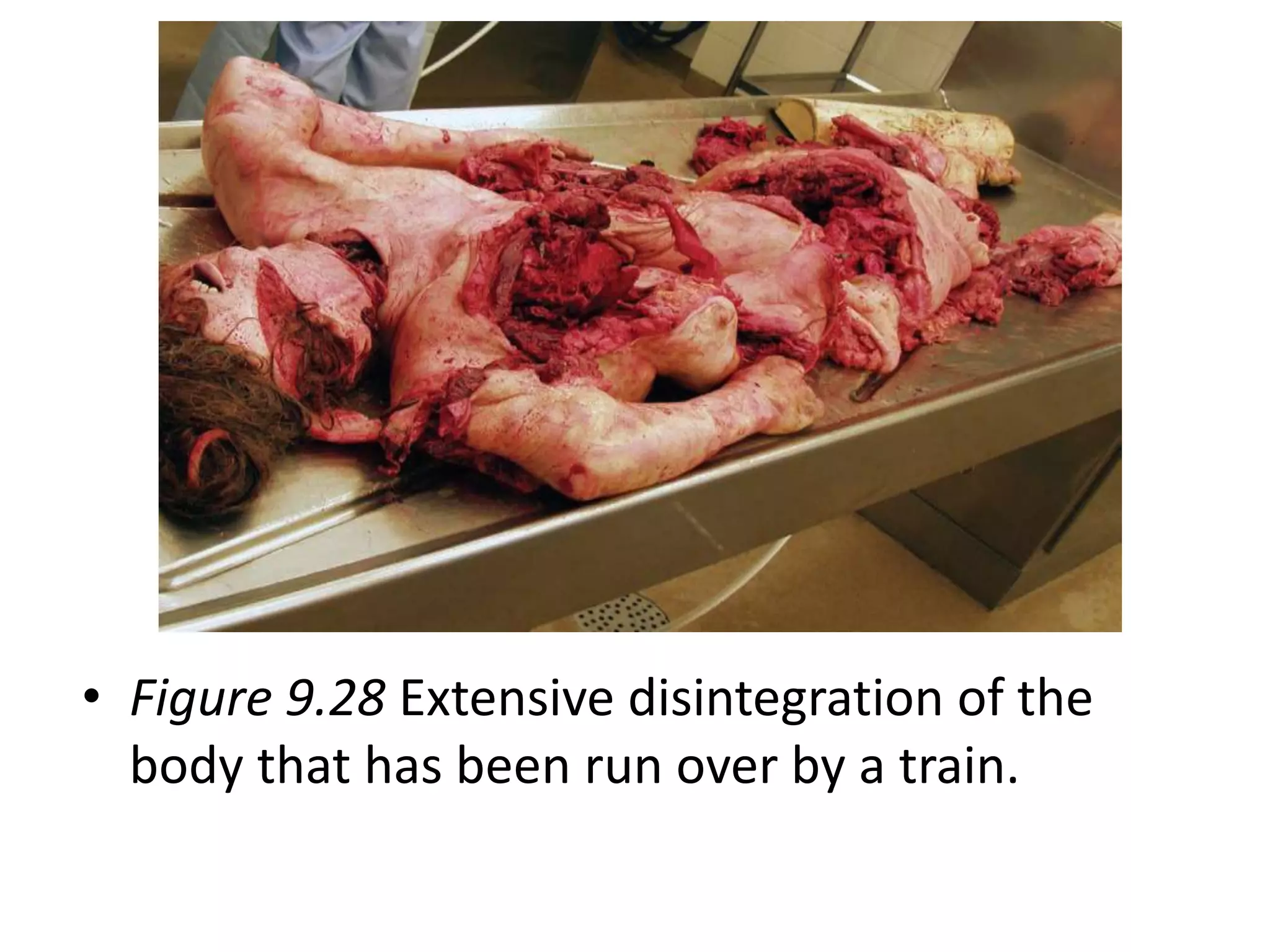 Road & railway injury (suicidal) | PPTX
