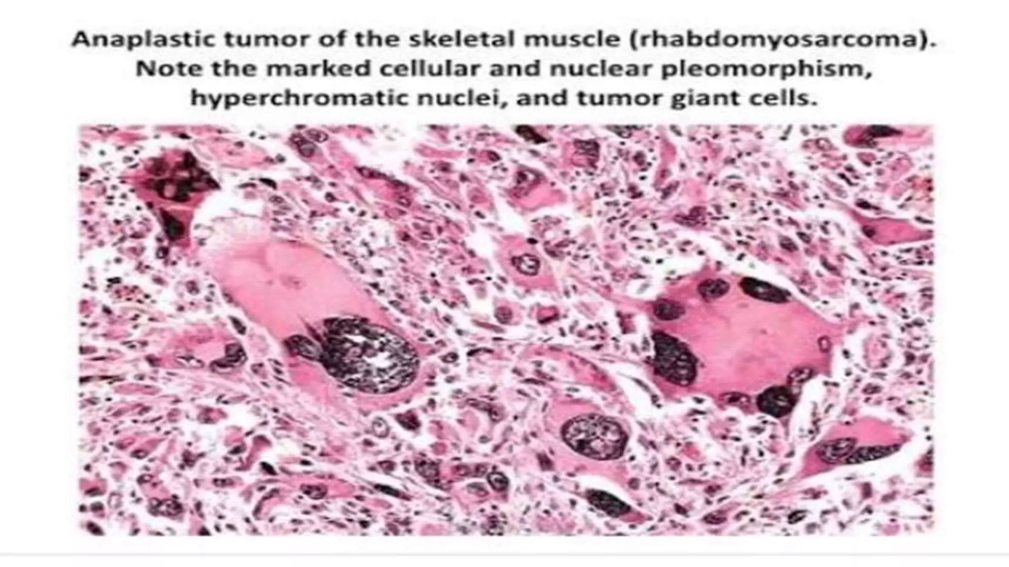 DIFFERENCE BETWEEN BENIGN AND MALIGNANT NEOPLASM (CANCER) | PPTX