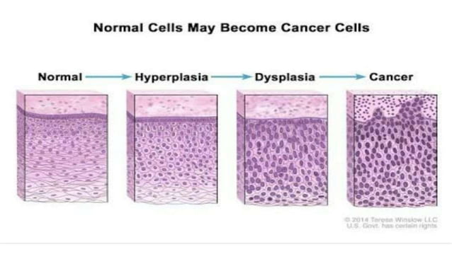 DIFFERENCE BETWEEN BENIGN AND MALIGNANT NEOPLASM (CANCER) | PPT DIFFERENCE BETWEEN BENIGN AND MALIGNANT NEOPLASM (CANCER) | PPT
