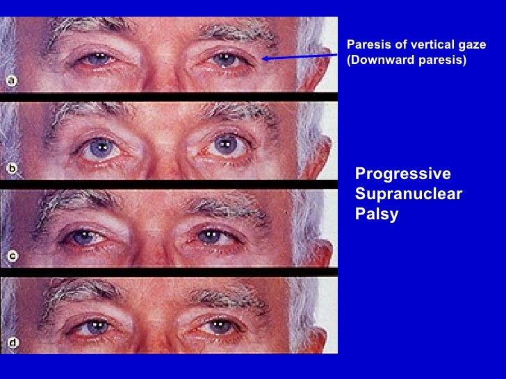 Robbins Alzheimers Dementia Toma 2006