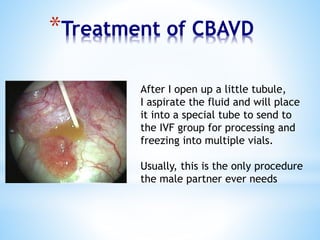 Robert Oates, M.D. - Microsurgical Epididymal Sperm Aspiration | PDF