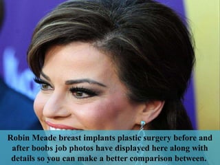 Robin Meade Before And After Plastic Surgery