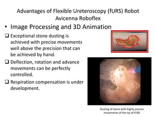 World’s First Flexible Ureteroscopy Robot | PDF