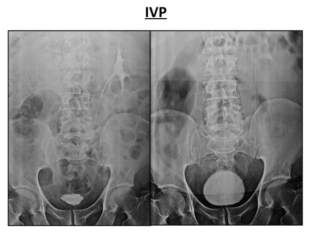 Robotic assisted laparoscopic right nephrectomy | PPT