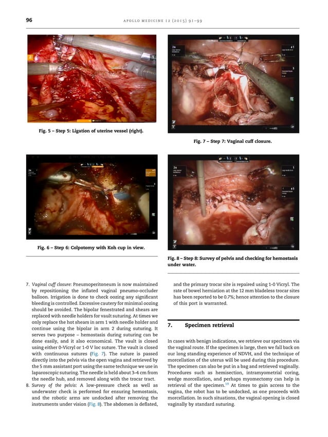 Robotic hysterectomy: A review of indications, technique, outcome, and complications | PDF