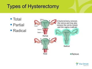 Women's Connection: Robotic Hysterectomy | PPT